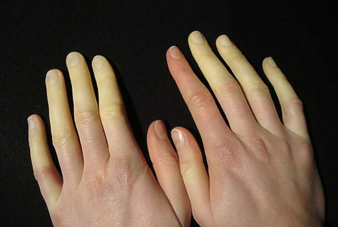 Σύνδρομο Raynaud: Το απλό τεστ που δείχνει αν έχετε τη διαταραχή που ...
